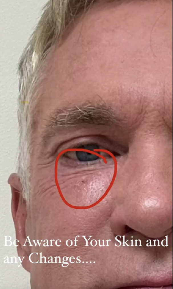 'GMA': Sam Champion Returns to Show With Face Scarred After Cancer ...