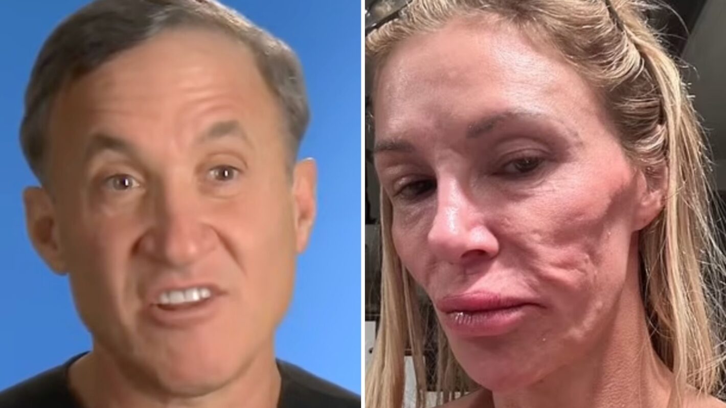 'Botched' Surgeon Dr. Terry Dubrow Shares Views on Brandi Glanville's 'Parasite' Face